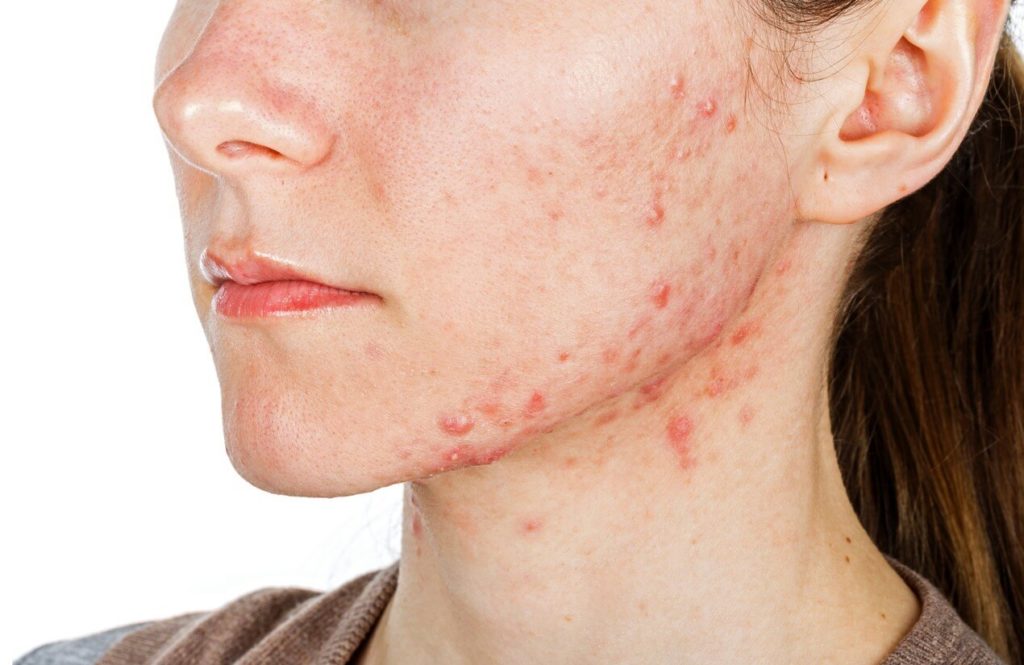 Problème de peau : comment s'en débarrasser